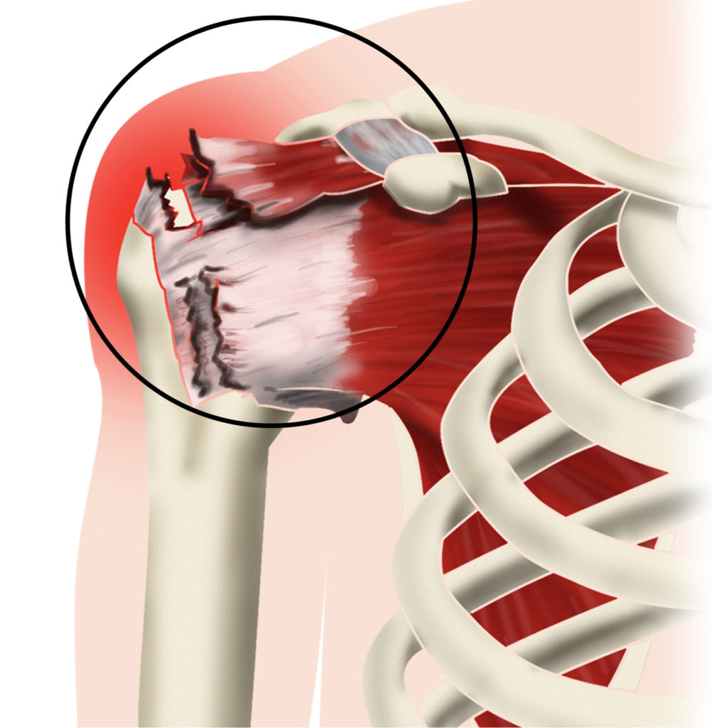 Rotator Cuff Tear Repair - Best Practice Health