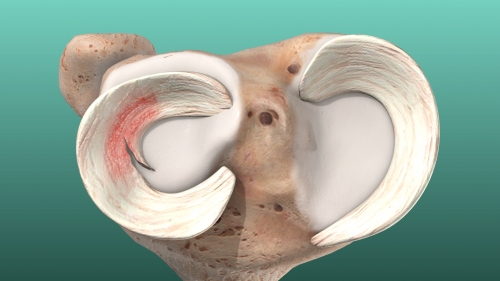 Meniscectomy & Meniscus Repair - Phoenix Spine & Joint