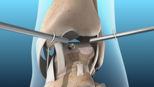 Ankle Ligament Reconstruction - Phoenix Spine & Joint