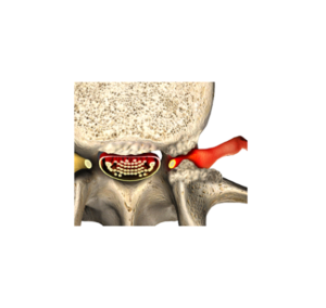 SuperPATH Hip Replacement Surgery - Phoenix Spine & Joint