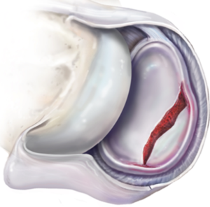 How to end the sad cycle of shoulder dislocation - Best Practice Health