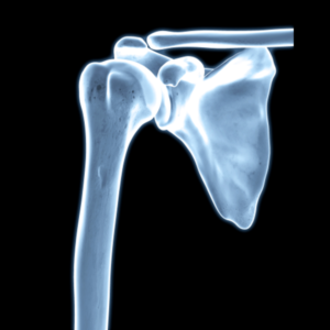 How to end the sad cycle of shoulder dislocation - Best Practice Health