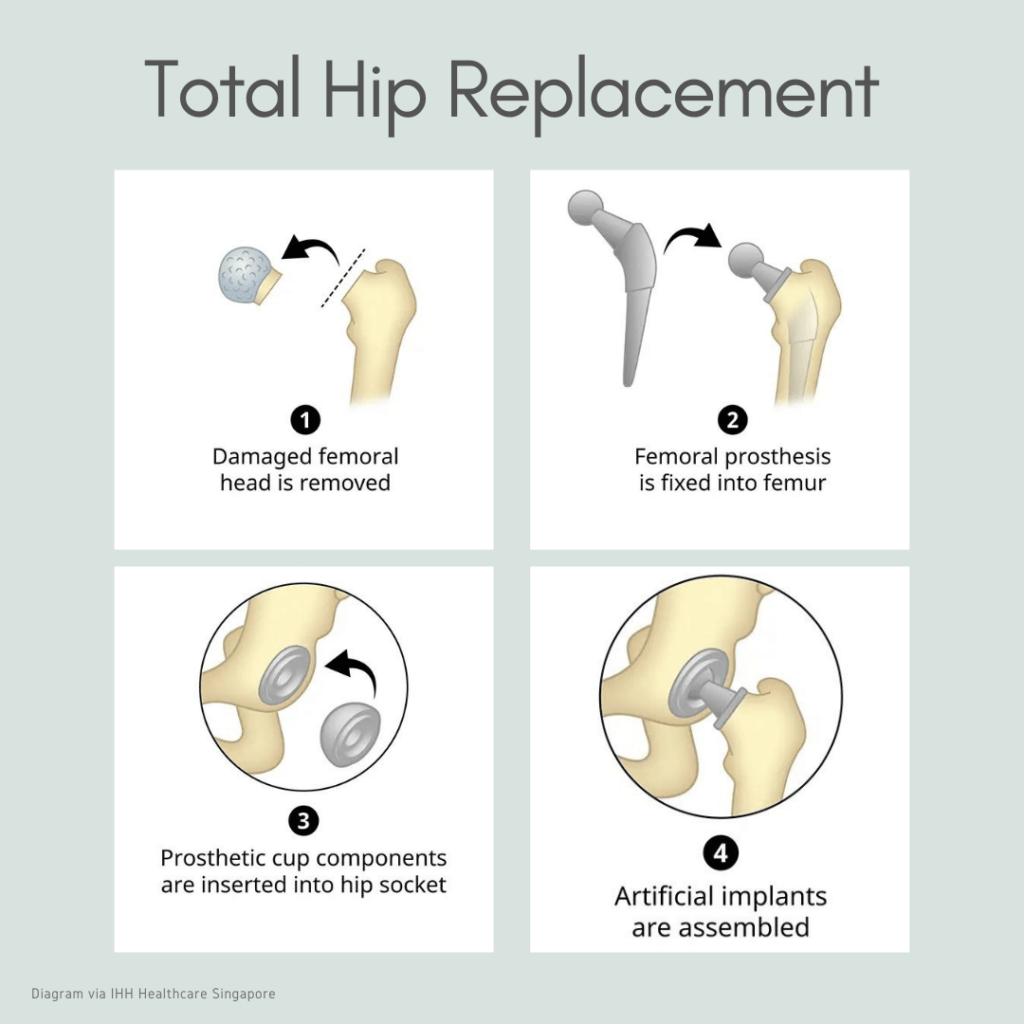 Hip replacement surgery: from pickleball to hip pain and back! - Best ...