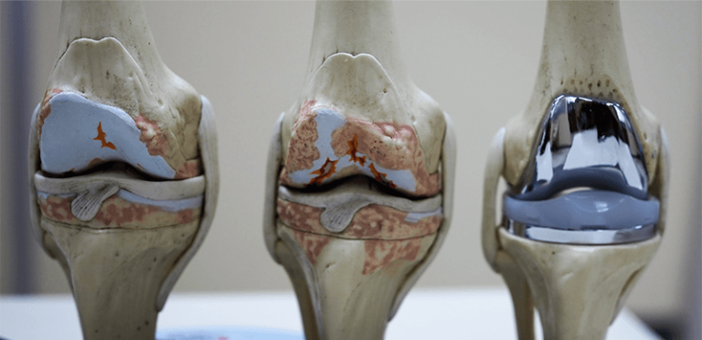 Total knee replacement after a torn meniscus: what you should know ...